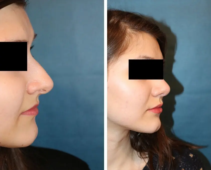 Nasen OP Vorher-Nachher | Dr. Pichelmaier, Wien