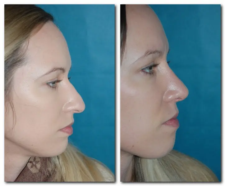 Nasen OP Vorher-Nachher | Dr. Pichelmaier, Wien
